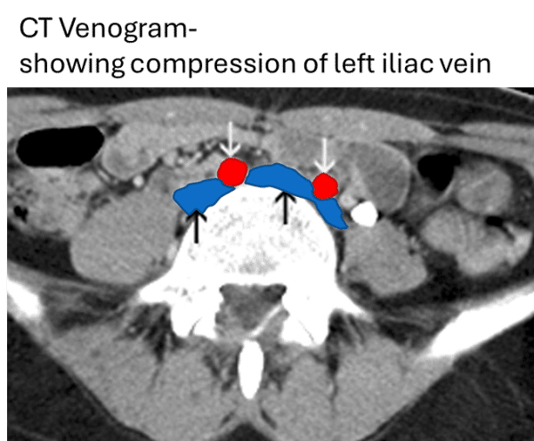 Iliac Vein Compression Syndrome: A Cause Of Leg Swelling