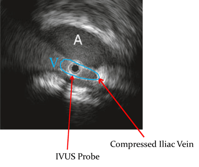 Iliac Vein Compression Syndrome: A Cause Of Leg Swelling