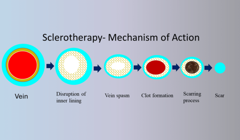 Sclerotherapy: An Effective Treatment Solution For Spider Veins
