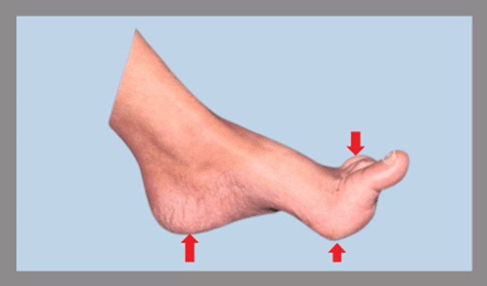 Diabetic Neuropathy and the Risk of Diabetic Foot Ulcers