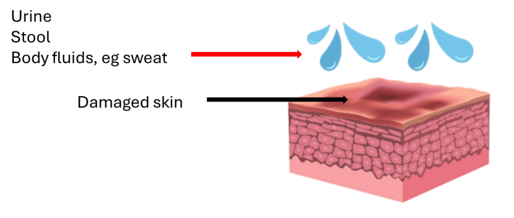 Prevention Pressure Ulcers (bedsores) in Bedridden Patients