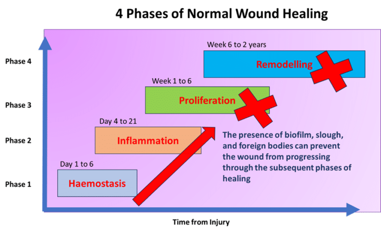 Chronic Non-Healing Wounds Biofilm Strategies for faster healing