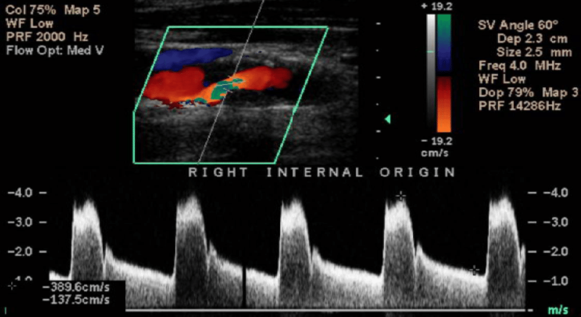Stroke and Carotid Artery Disease: A Complete Guide for Patients