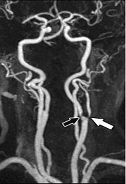 Stroke and Carotid Artery Disease: A Complete Guide for Patients